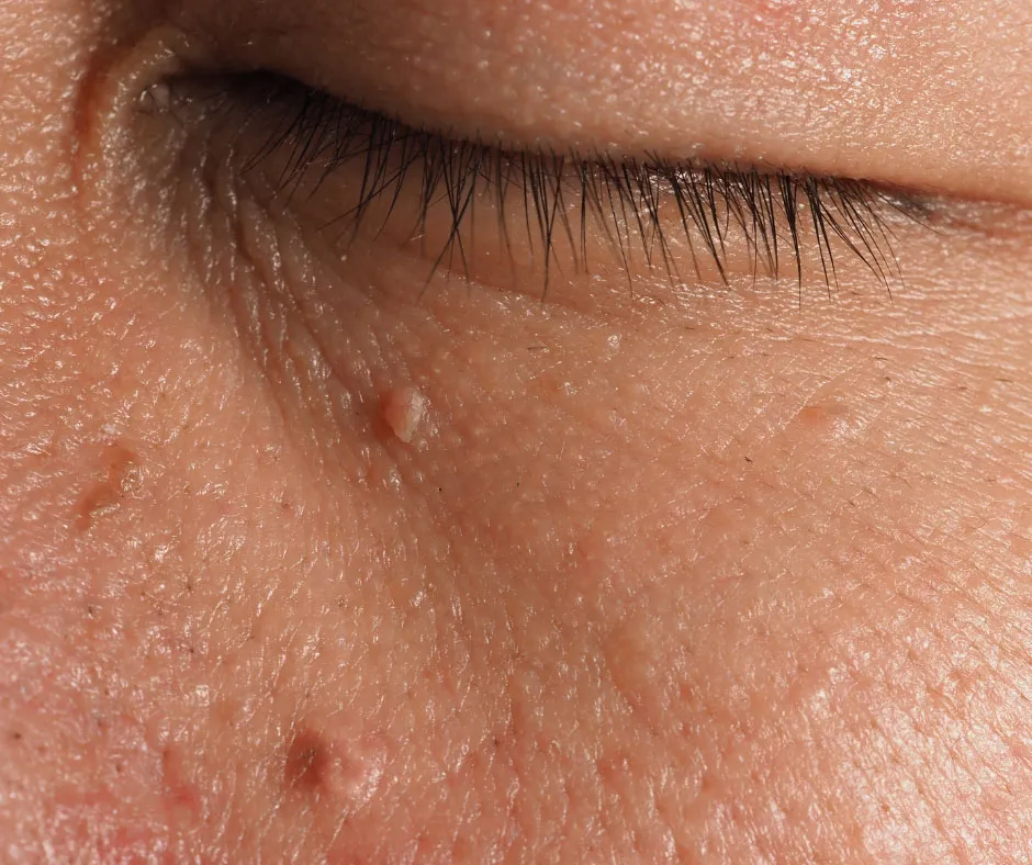 Skin Lesions / Warts / Skin Tags - Dermoperfection