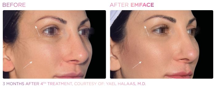 What is EMFACE, now at Dermoperfection? - Dermoperfection