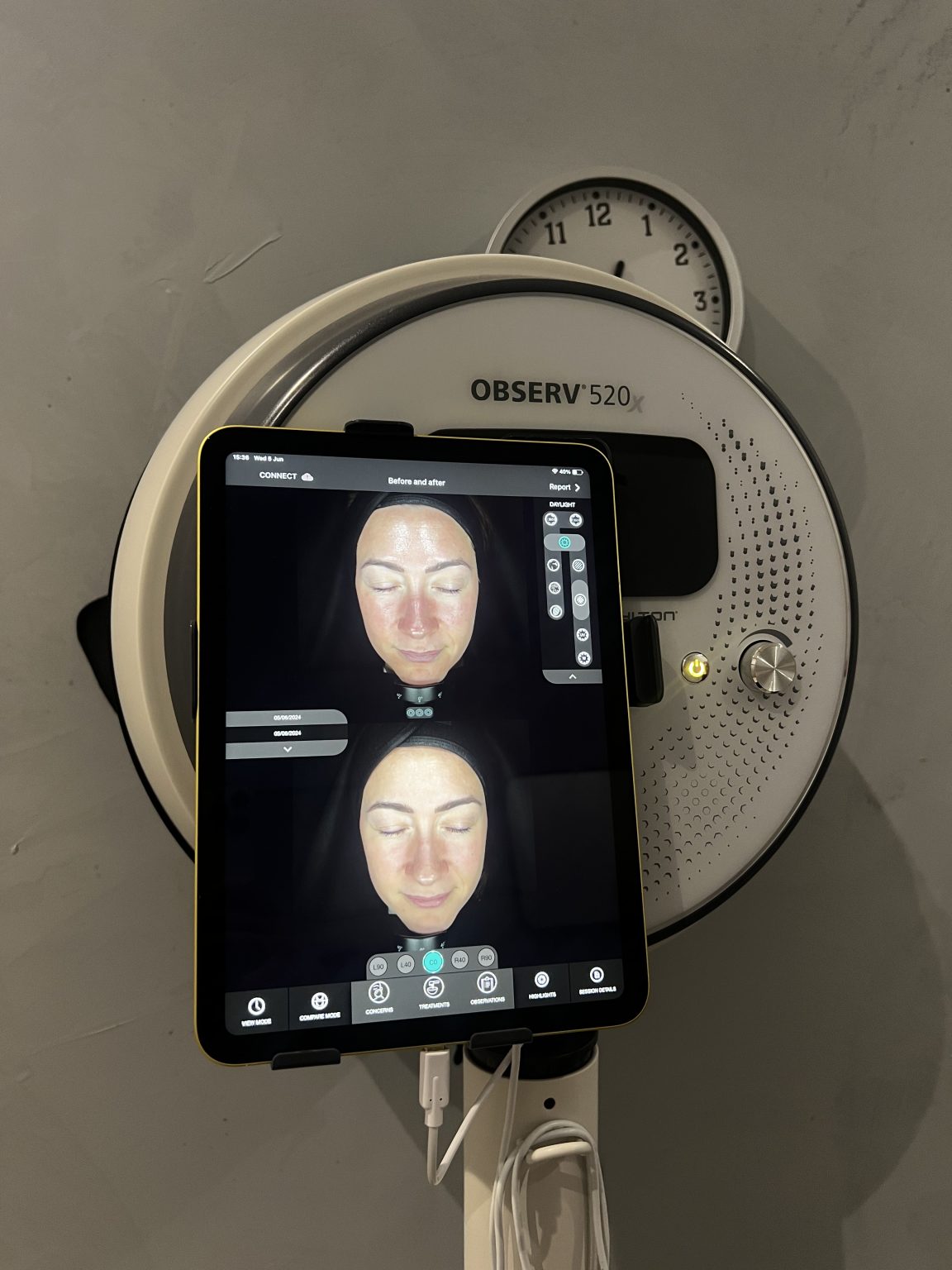Introducing Observ 520x skin analysis! - Dermoperfection